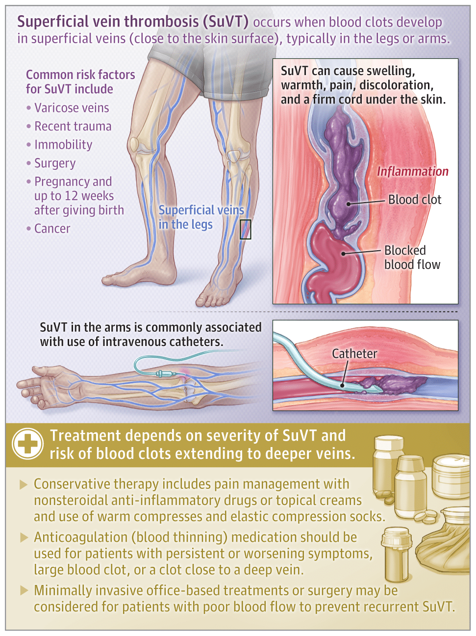 What is Superficial Vein Thrombosis (SVT)? - The Vein Center of ...